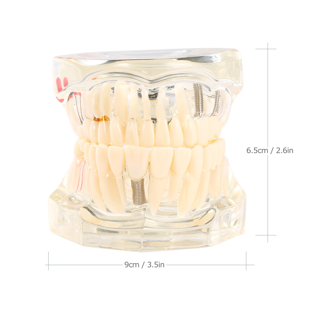 Implant Study Model – Javed Dental Supply